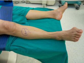 Wrong Site Surgery Attorneys in St. Louis | Sansone & Lauber