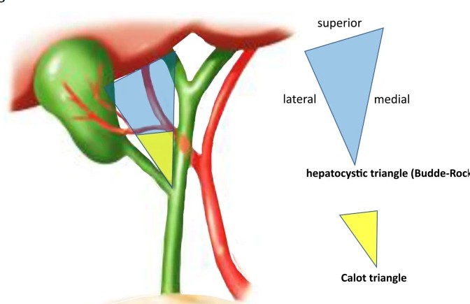 When Gallbladder Surgery Goes Wrong: Understanding Laparoscopic ...